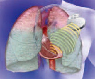 Advisa MRI 機能「OptiVol」 （条件付MRIシステム） ｜ MRI SureScan [Medtronic]
